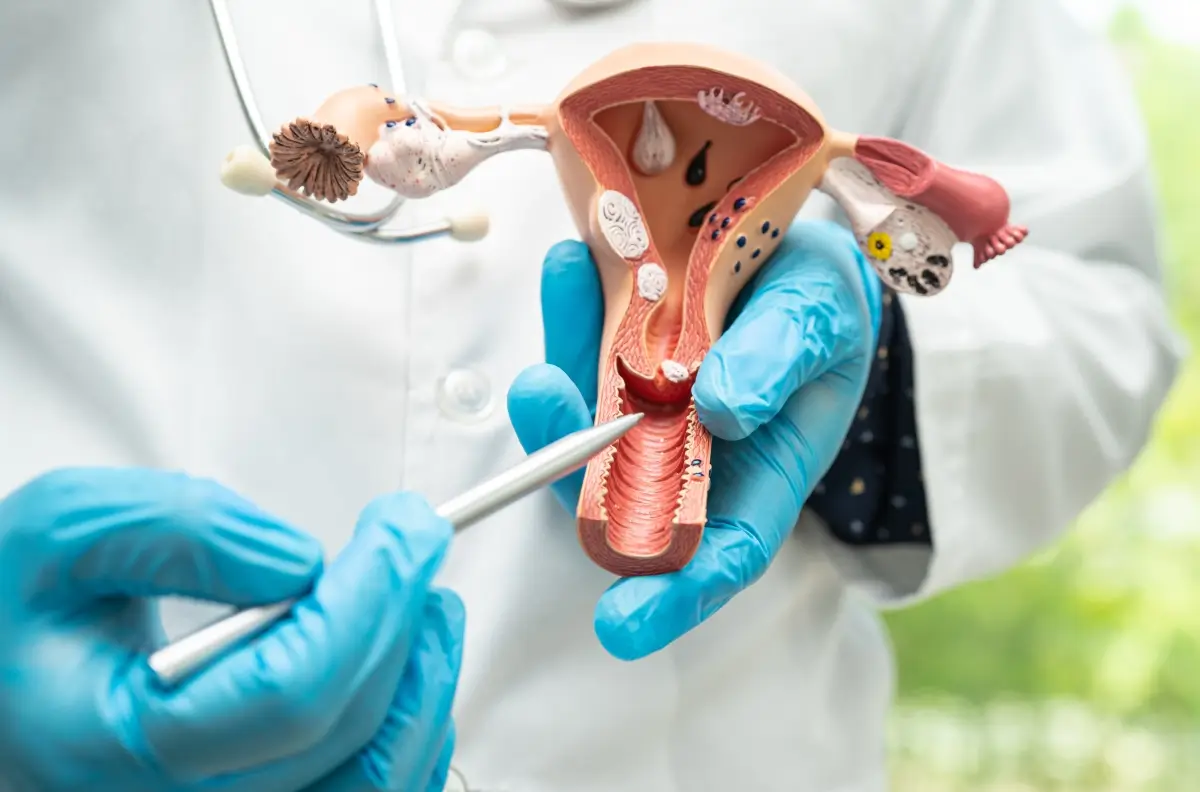 PCOS Causes, Symptoms, and Complications - Complete Guide